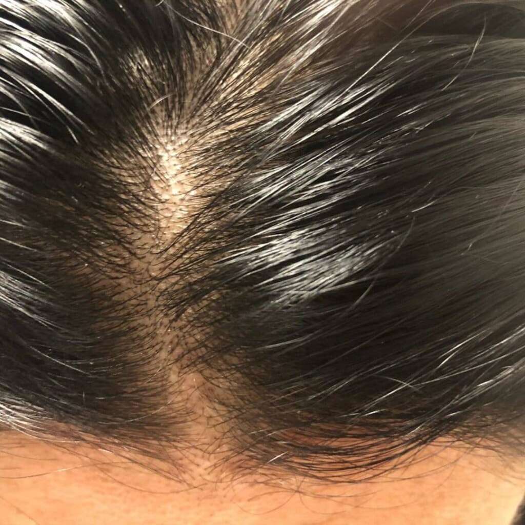 Seborrea o Grasa. ¿Por qué se produce? | SIMONE TRICHOLOGY