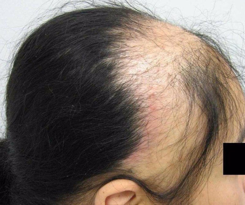 HAIR LOSS Solutions | SIMONE TRICHOLOGY Advice